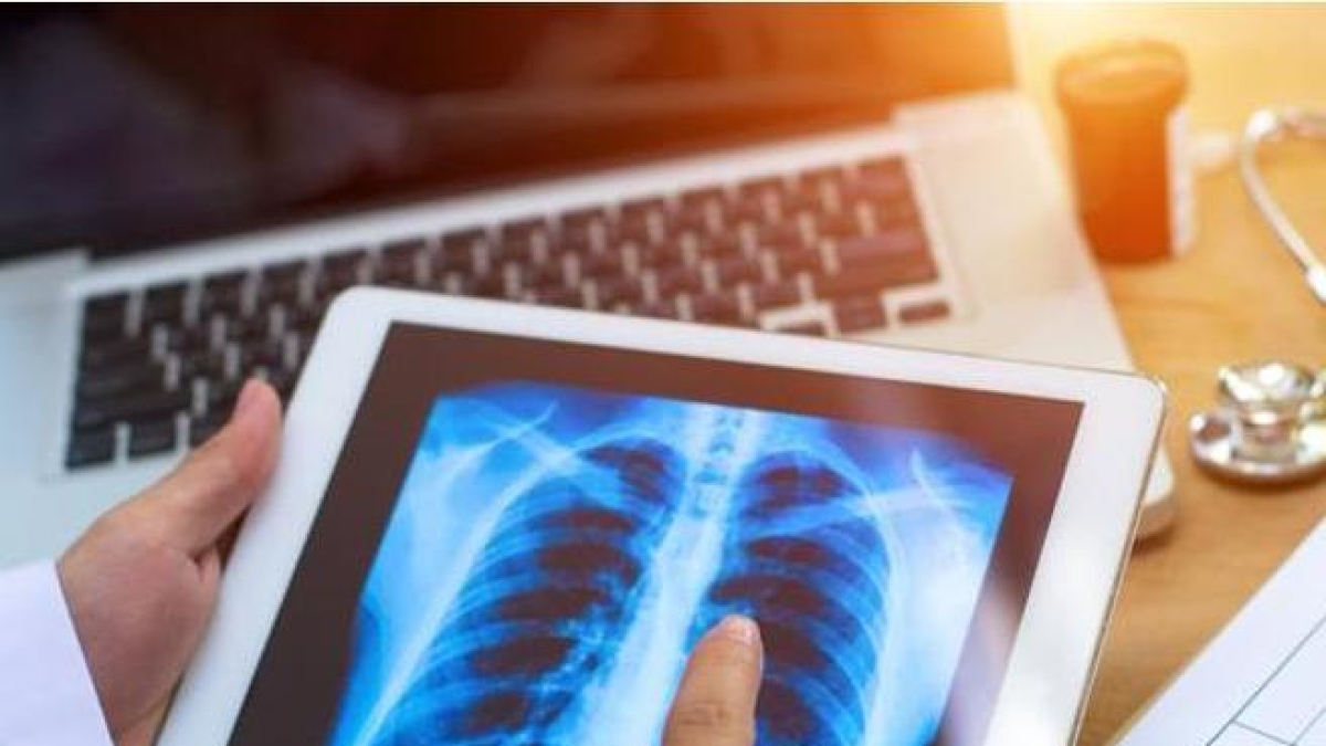 Cancer du poumon : le test qui peut sauver la vie des personnes les ...
